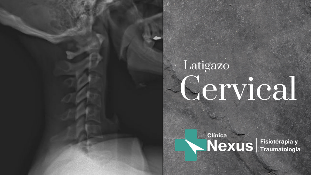 Latigazo cervical: qué es, causas, síntomas y tratamiento - Nexus-Activamed